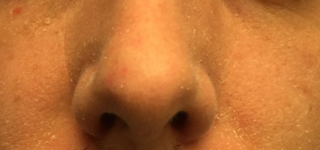 Demodex Milben beim Menschen im Gesicht, Haarbalgmilben Therapie