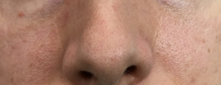 Demodex Milben beim Menschen im Gesicht, Haarbalgmilben Therapie