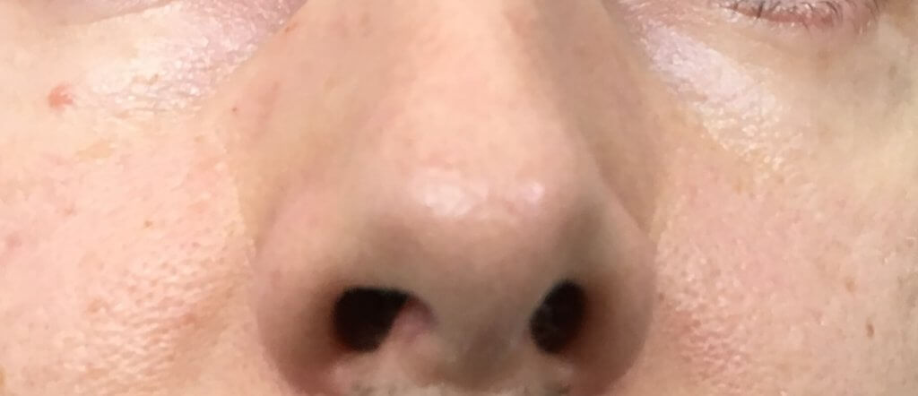 Demodex Milben beim Menschen im Gesicht, Haarbalgmilben Therapie